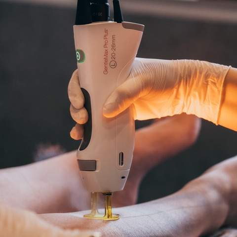 DE BESTE LASER OMTRENT LASERONTHARING: GENTLE MAX PRO PLUS - Sweet ...